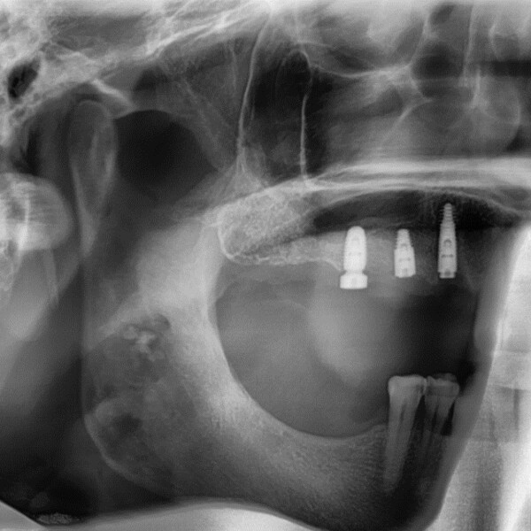 Implant rehabilitation with GTB SINUS LIFT | ADVAN Implantology